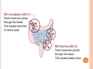 Irritable bowel syndrome | PPT