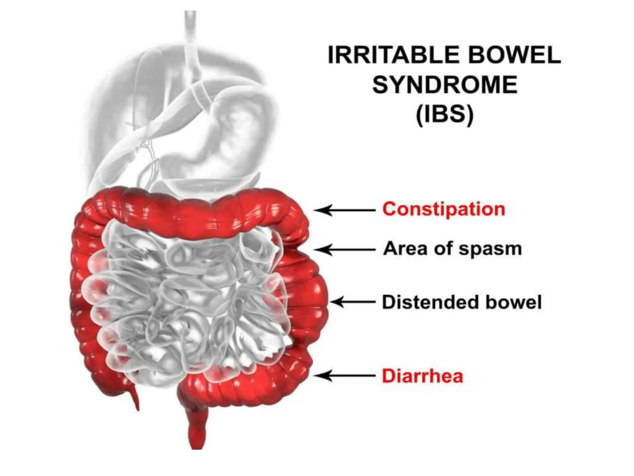irritable bowl syndrome.pptx and irritable bowel | PPTX