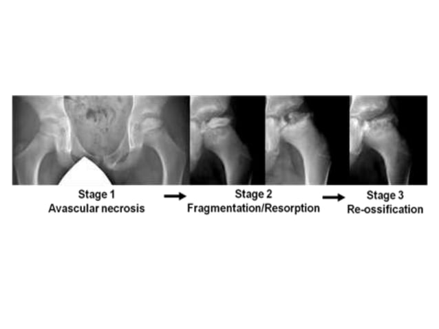 Irritable hip and perthe's disease | PPTX | Physical Therapy | Wellness