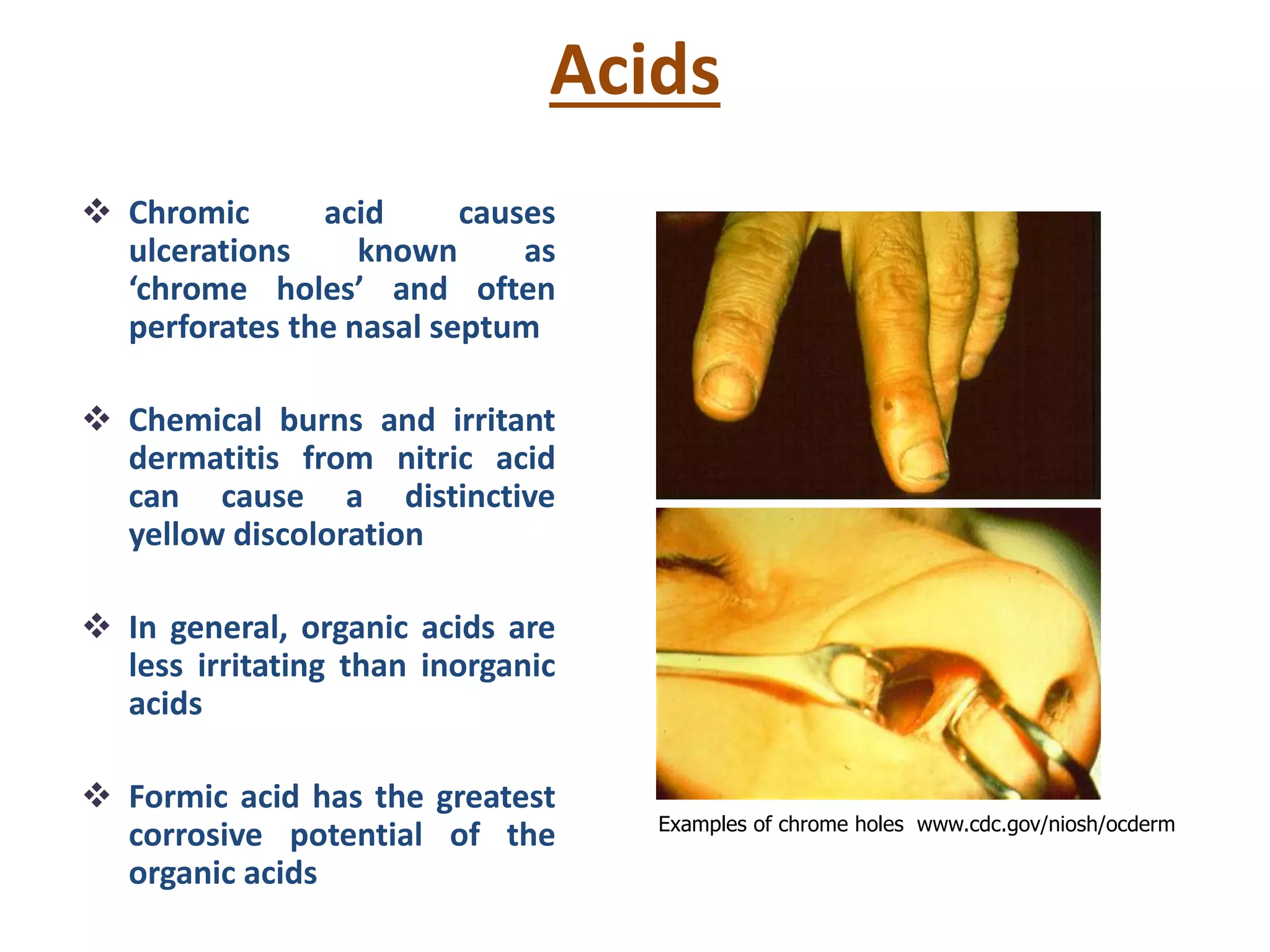 Irritant contact dermatitis | PPTX