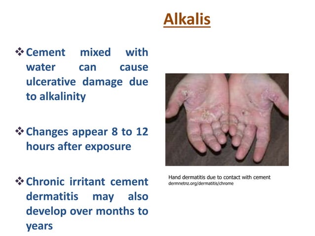 Irritant contact dermatitis | PPTX