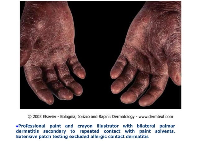Irritant contact dermatitis | PPTX