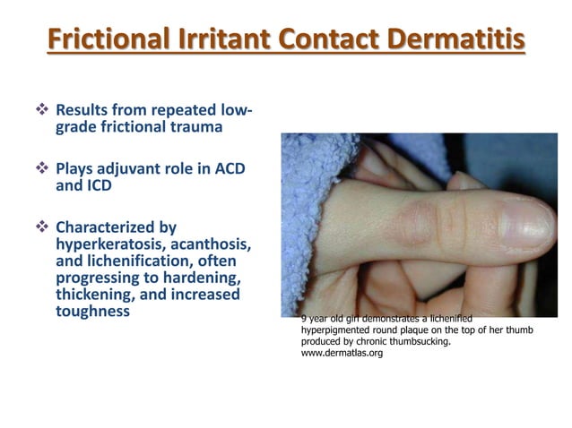 Irritant contact dermatitis | PPTX