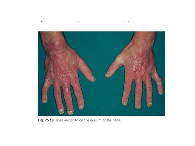 Irritant contact dermatitis | PPTX