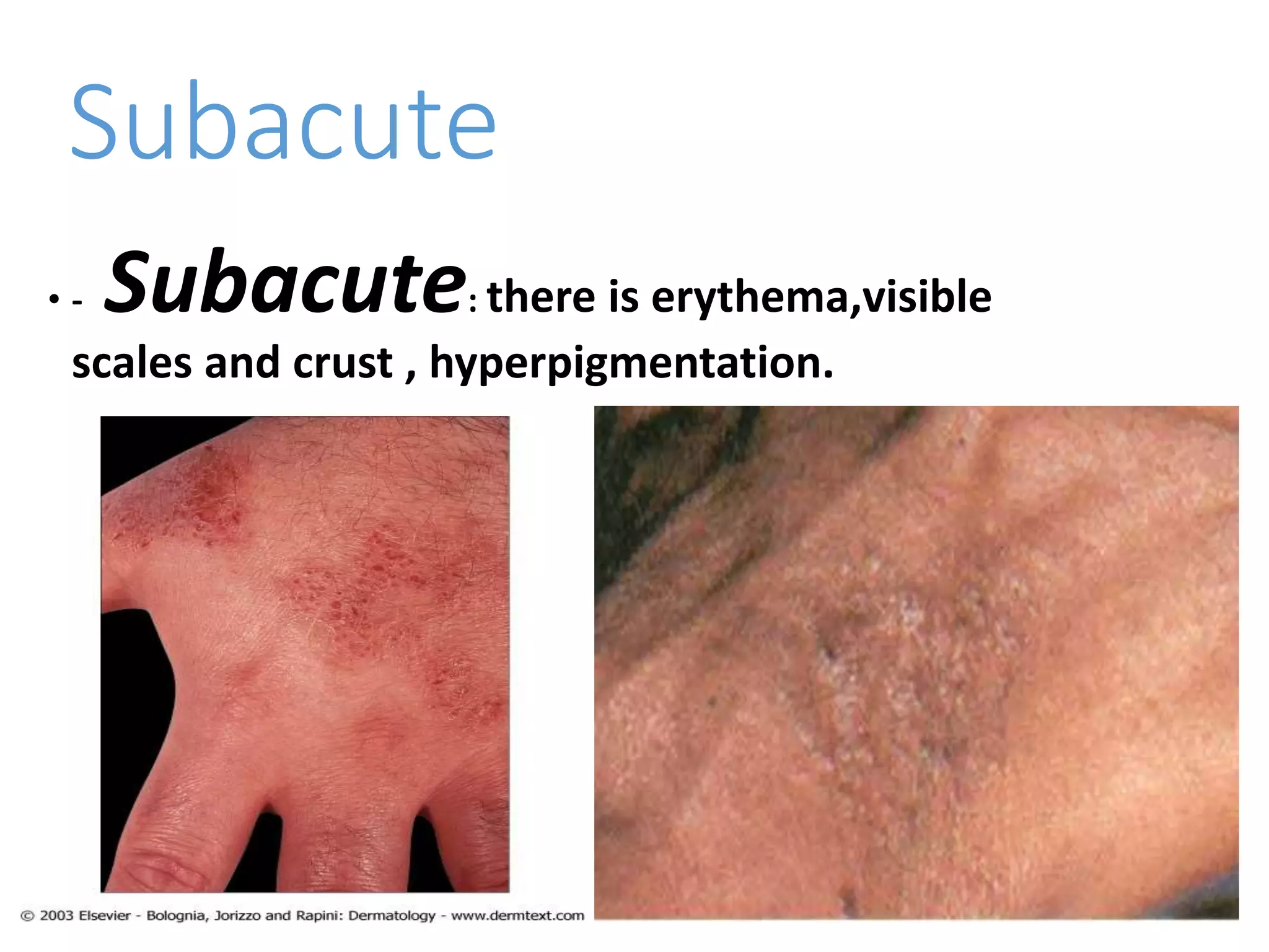 Irritant contact dermatitis | PPTX