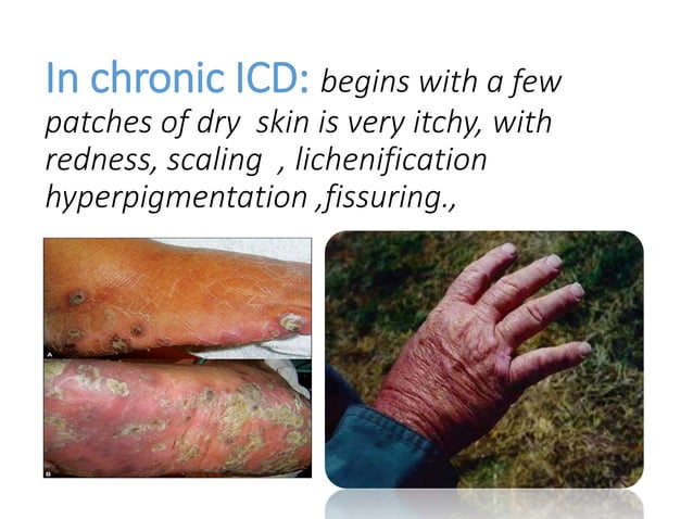 Irritant contact dermatitis | PPTX