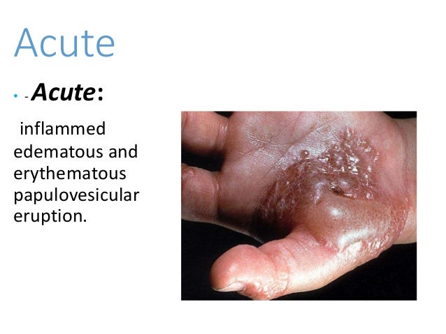 Irritant contact dermatitis