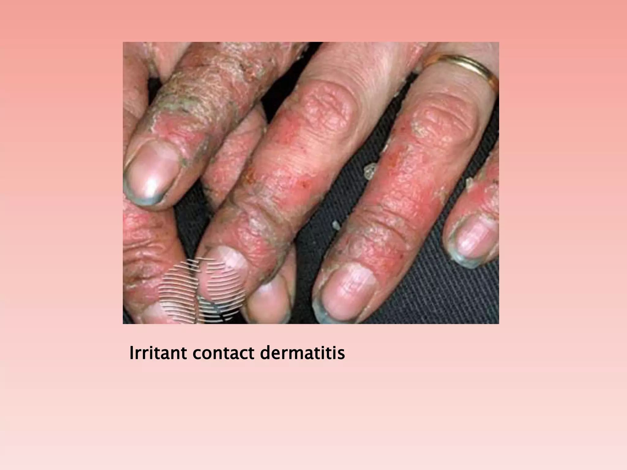 Irritant contact dermatitis by dr maria saeed | PPT