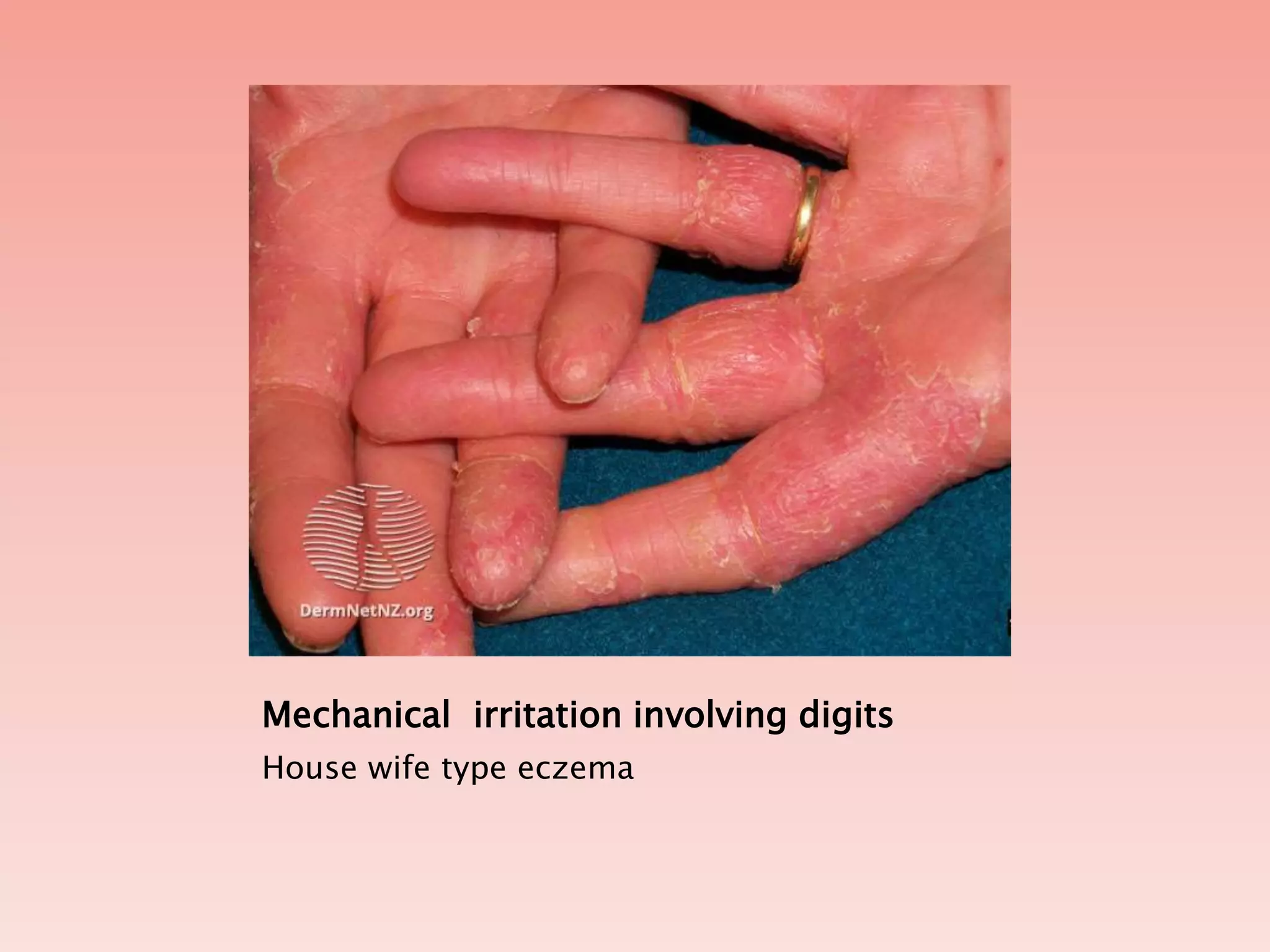 Irritant contact dermatitis by dr maria saeed | PPT
