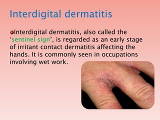Irritant contact dermatitis by dr maria saeed | PPT