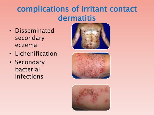 Irritant contact dermatitis by dr maria saeed | PPT