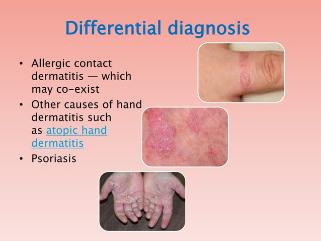 Irritant contact dermatitis by dr maria saeed | PPT