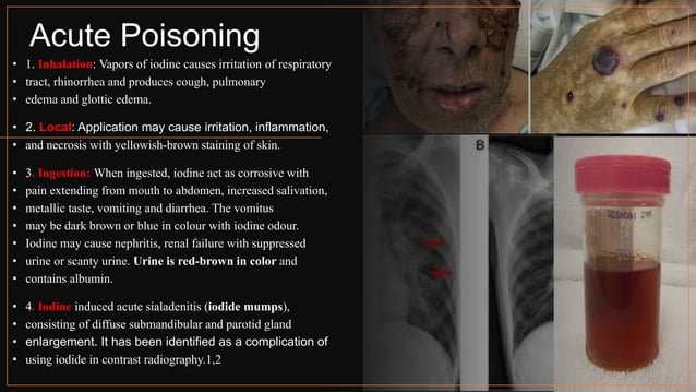 irritant poison final #poisoning # irritants # | PPTX | Digestive ...