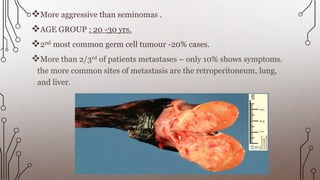 embryonal carcinoma | PPTX