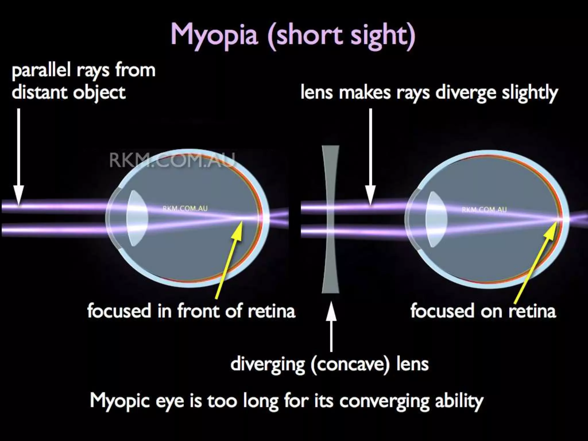 HUMAN EYE AND ITS DEFECTS | PPTX
