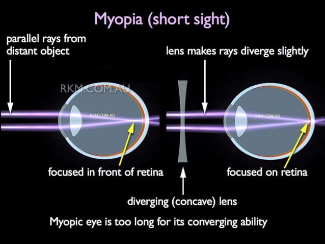 HUMAN EYE AND ITS DEFECTS | PPTX | Eye and Vision Conditions | Diseases ...