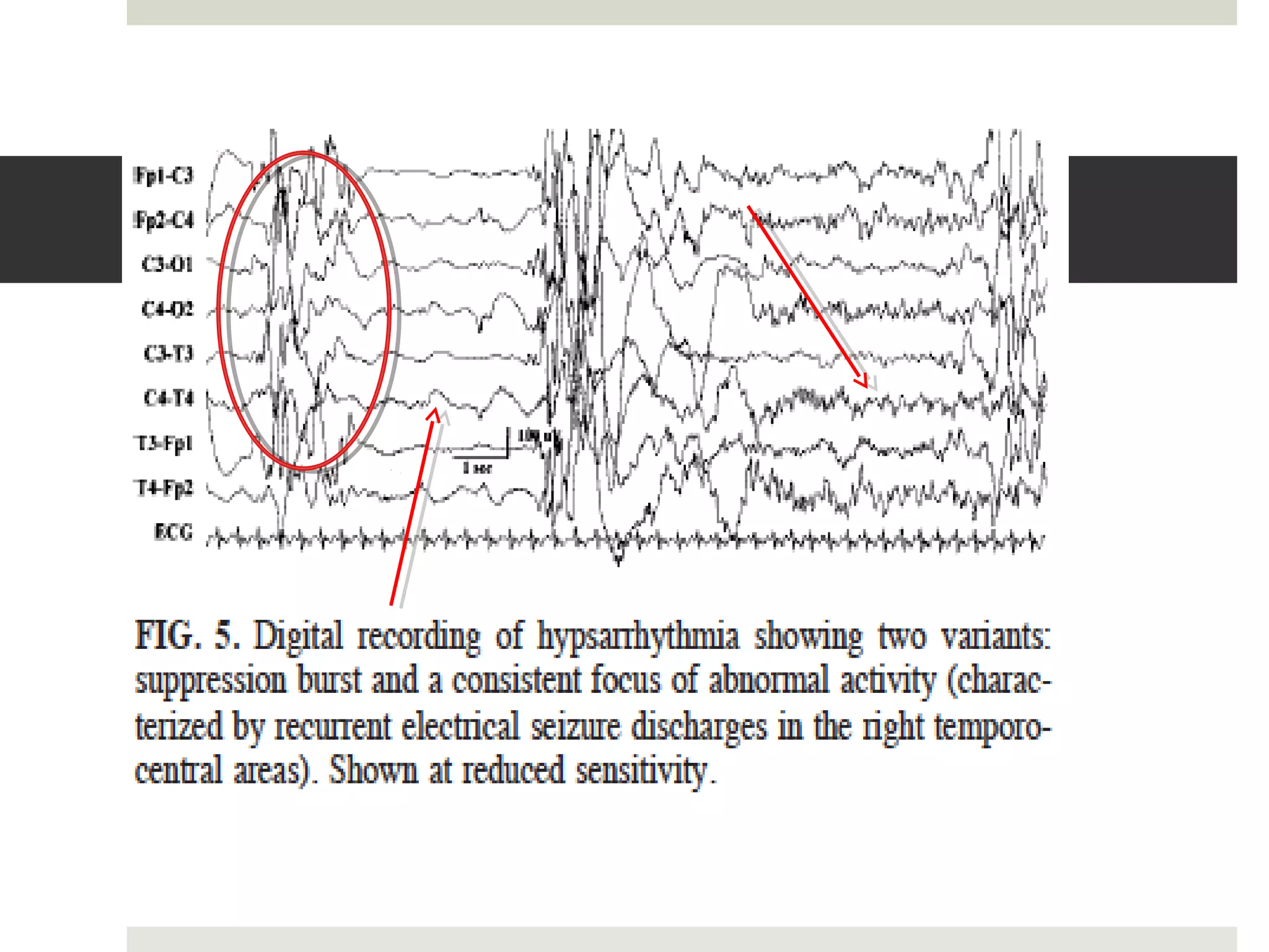 Infantile spasm and hypsarrythmia | PPT
