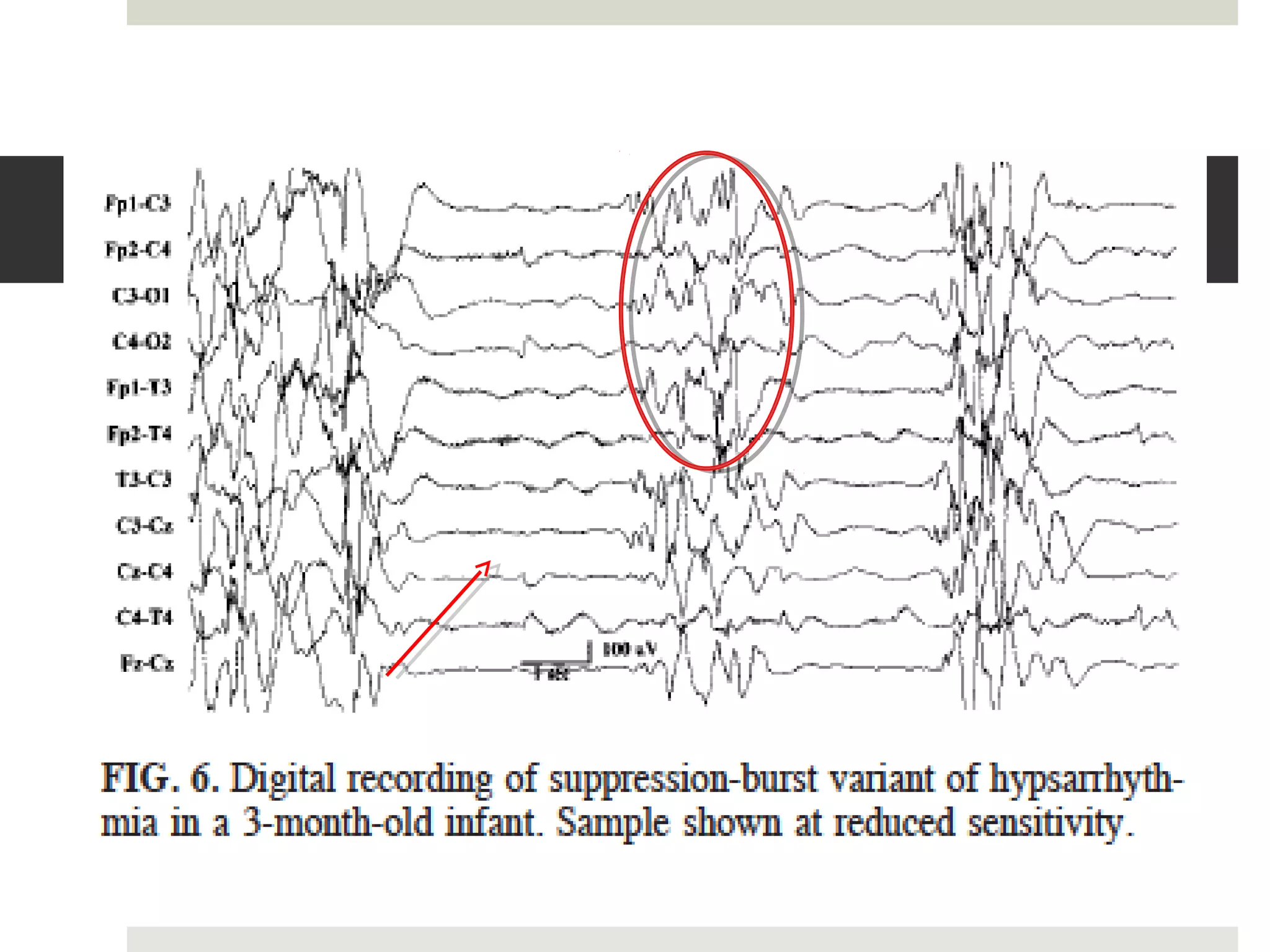 Infantile spasm and hypsarrythmia | PPT