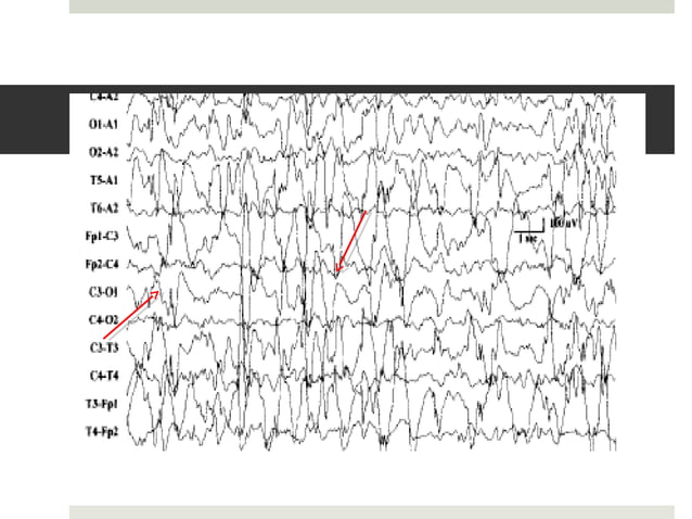 Infantile spasm and hypsarrythmia | PPT | Brain and Nervous System ...