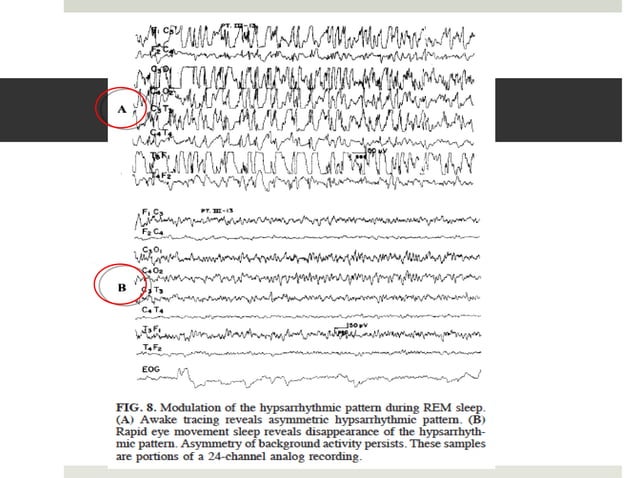 Infantile spasm and hypsarrythmia | PPT | Brain and Nervous System ...