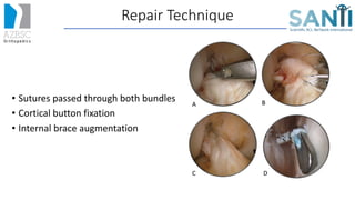 ACL Repair Vs Reconstruction, AZBSC Orthopedics, Scottsdale, AZ | PDF