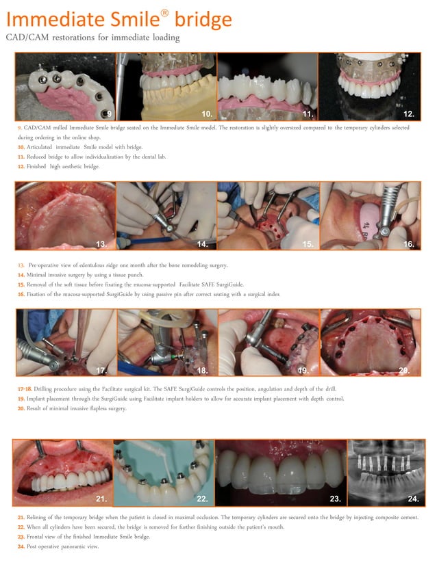 Immediate Smile bridge: Minimal invasive flapless surgery followed by immediate loading by Dr ...