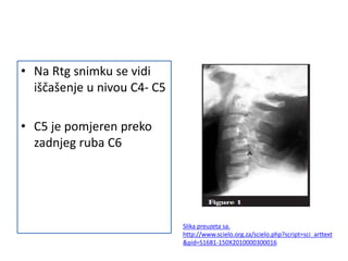 Iscasenje zglobova | PPT