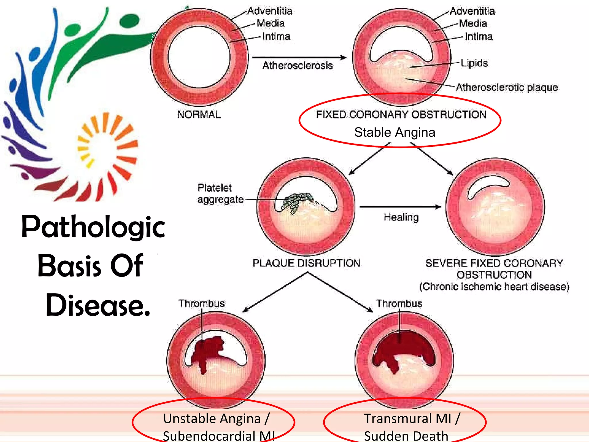 Ischemic heart disease, IHD, ihd, ischemic heart disease ischaemic ...