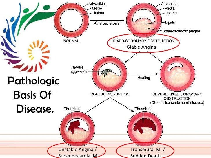 Ischemic heart disease, IHD, ihd, ischemic heart disease ischaemic