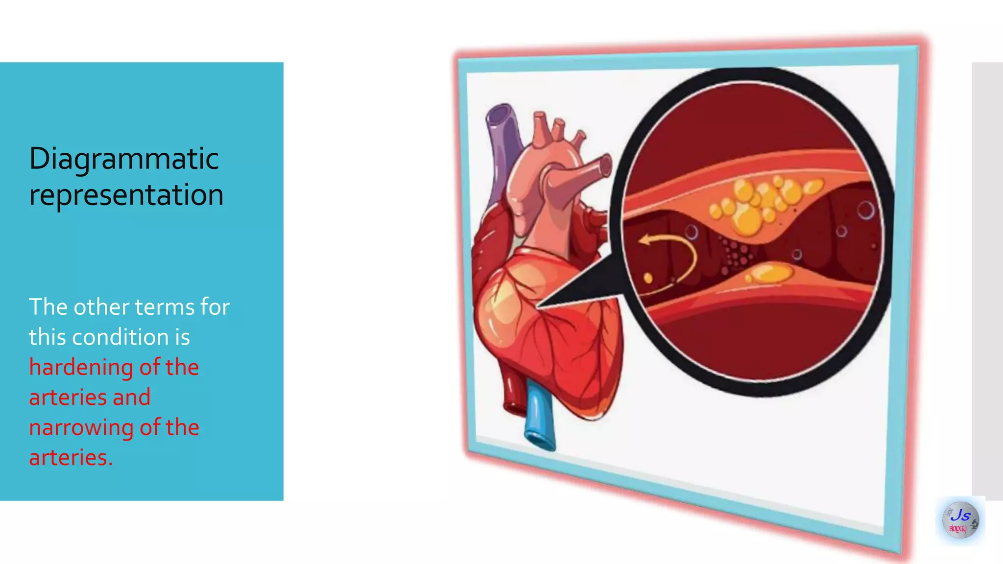 Ischaemic heart disease | PPT