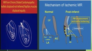 Ischaemic mr | PPTX