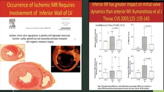 Ischaemic mr | PPTX