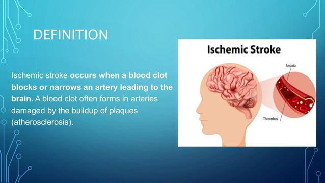 Ischaemic Stroke.pptx