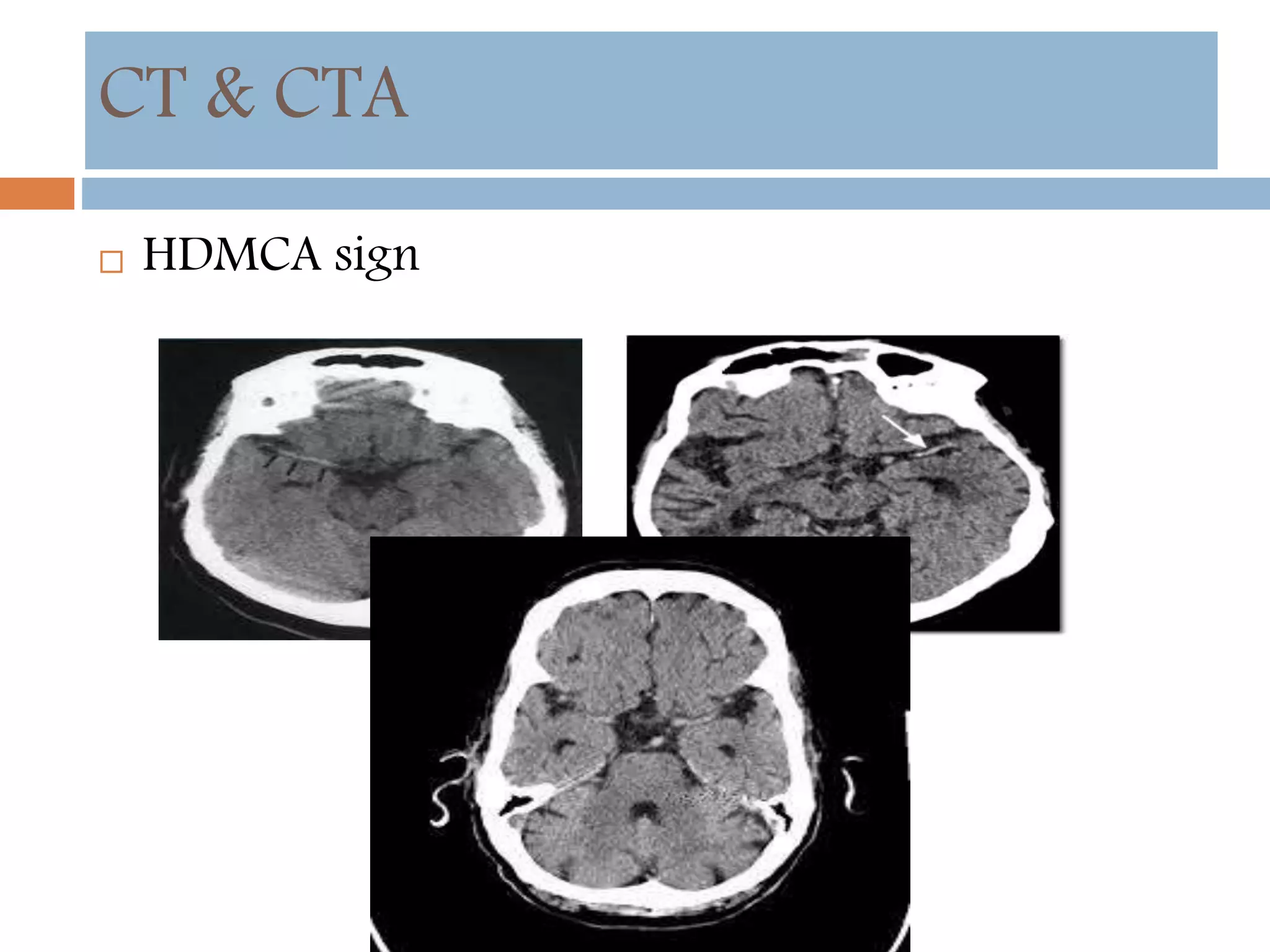 Ischaemic stroke | PPTX