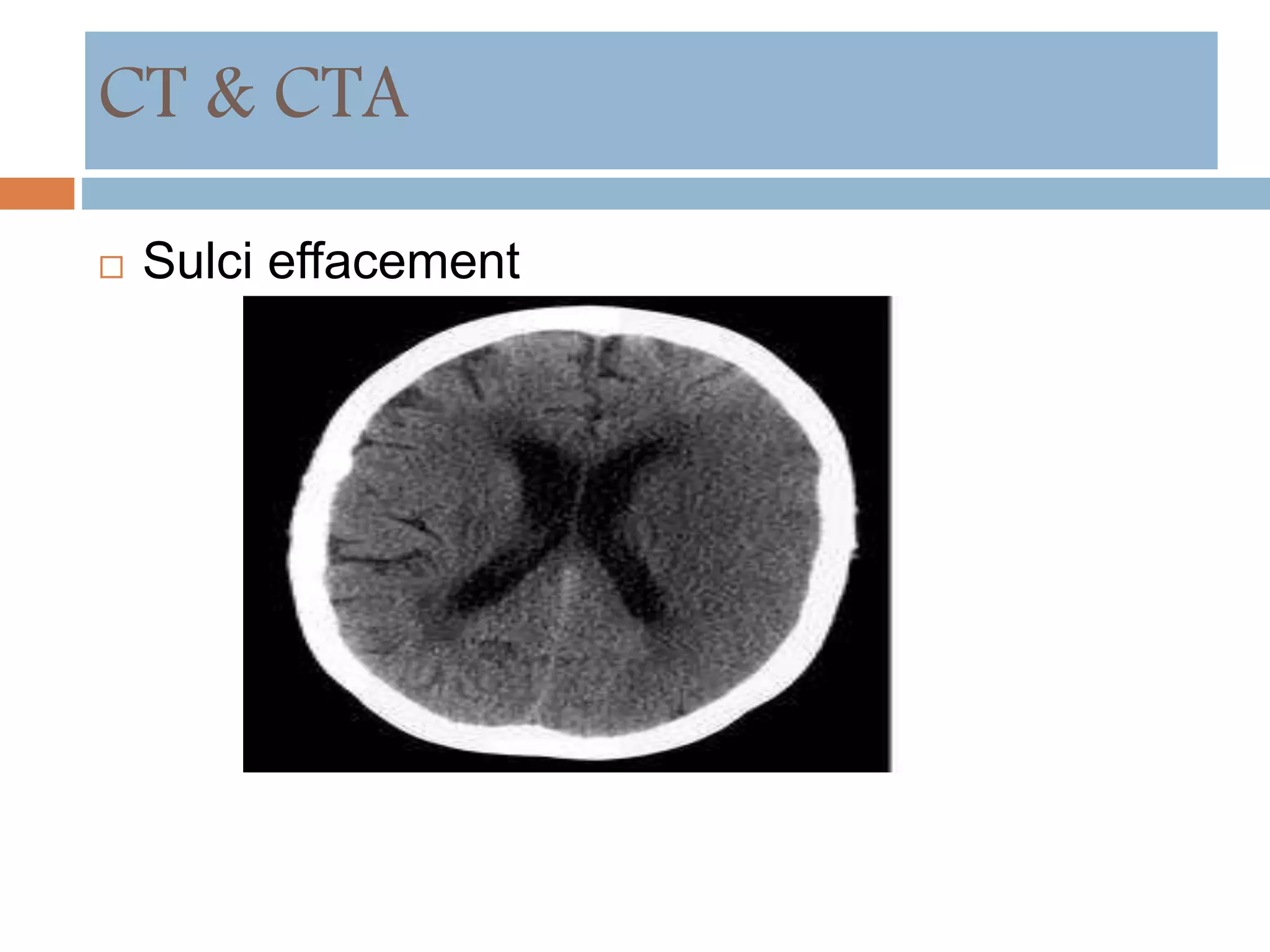Ischaemic stroke | PPTX