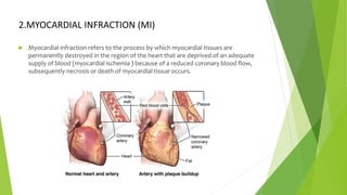 ISCHEAMIC HEART.pptx