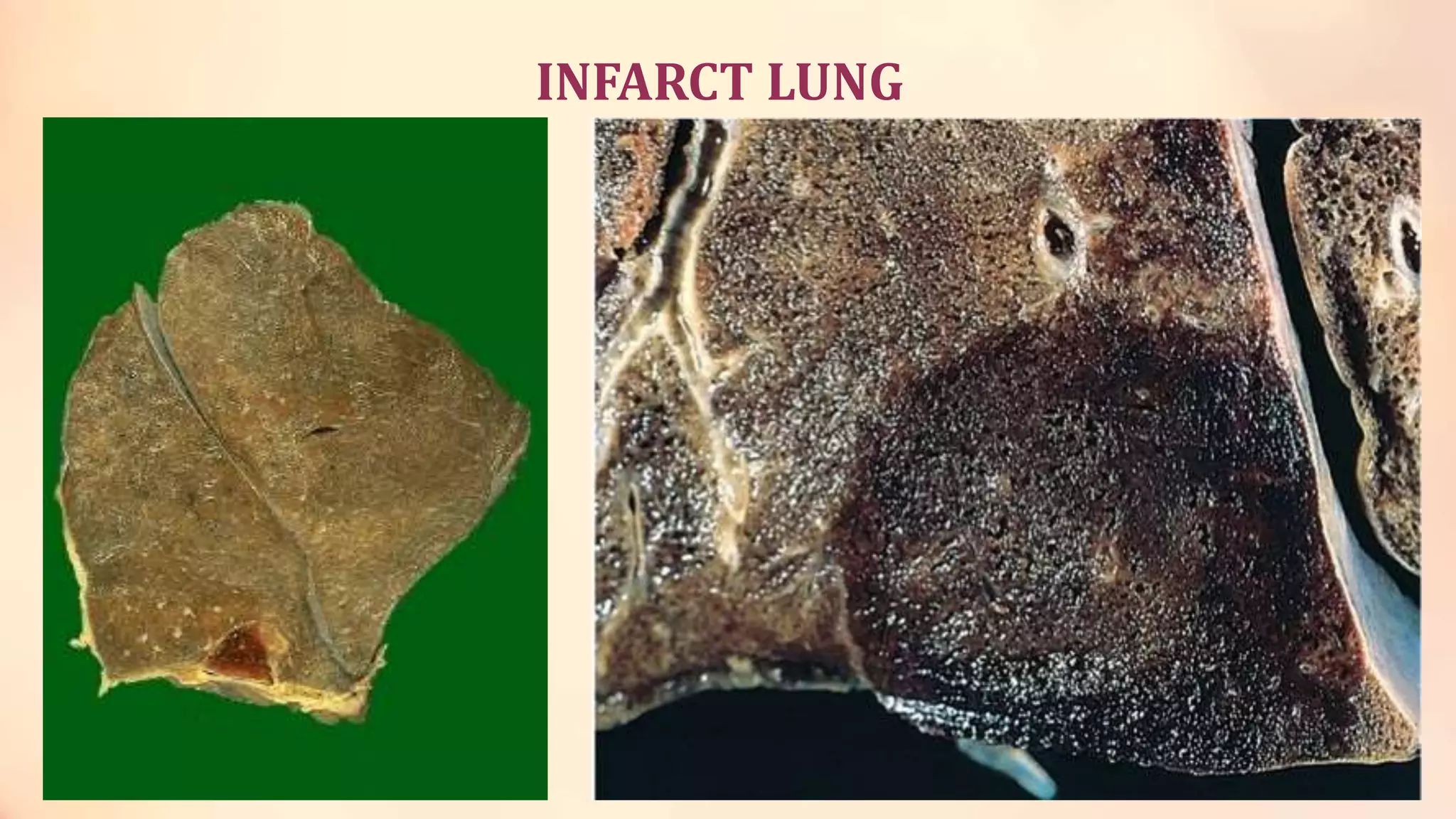 ischemia-and-infarction.ppt