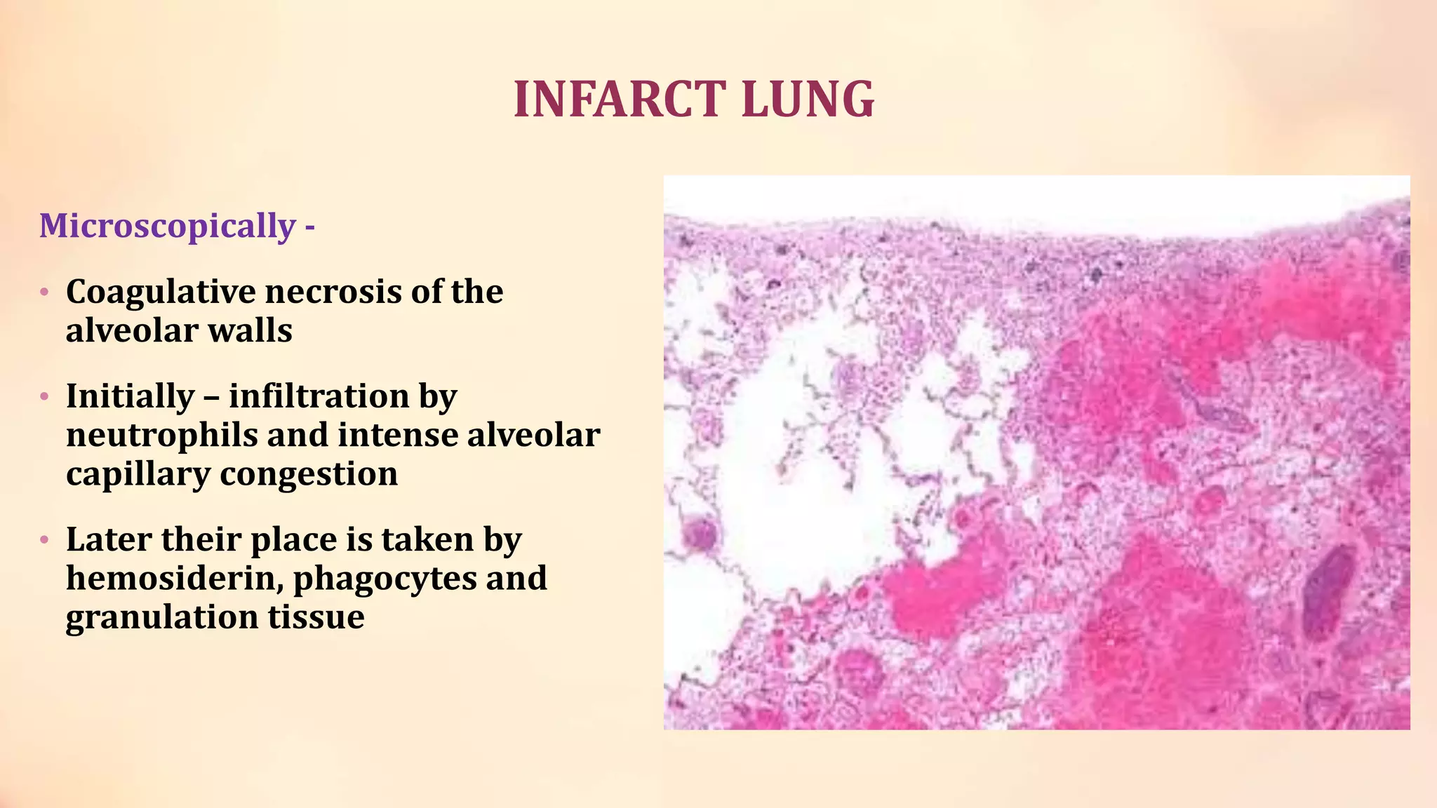 ischemia-and-infarction.ppt