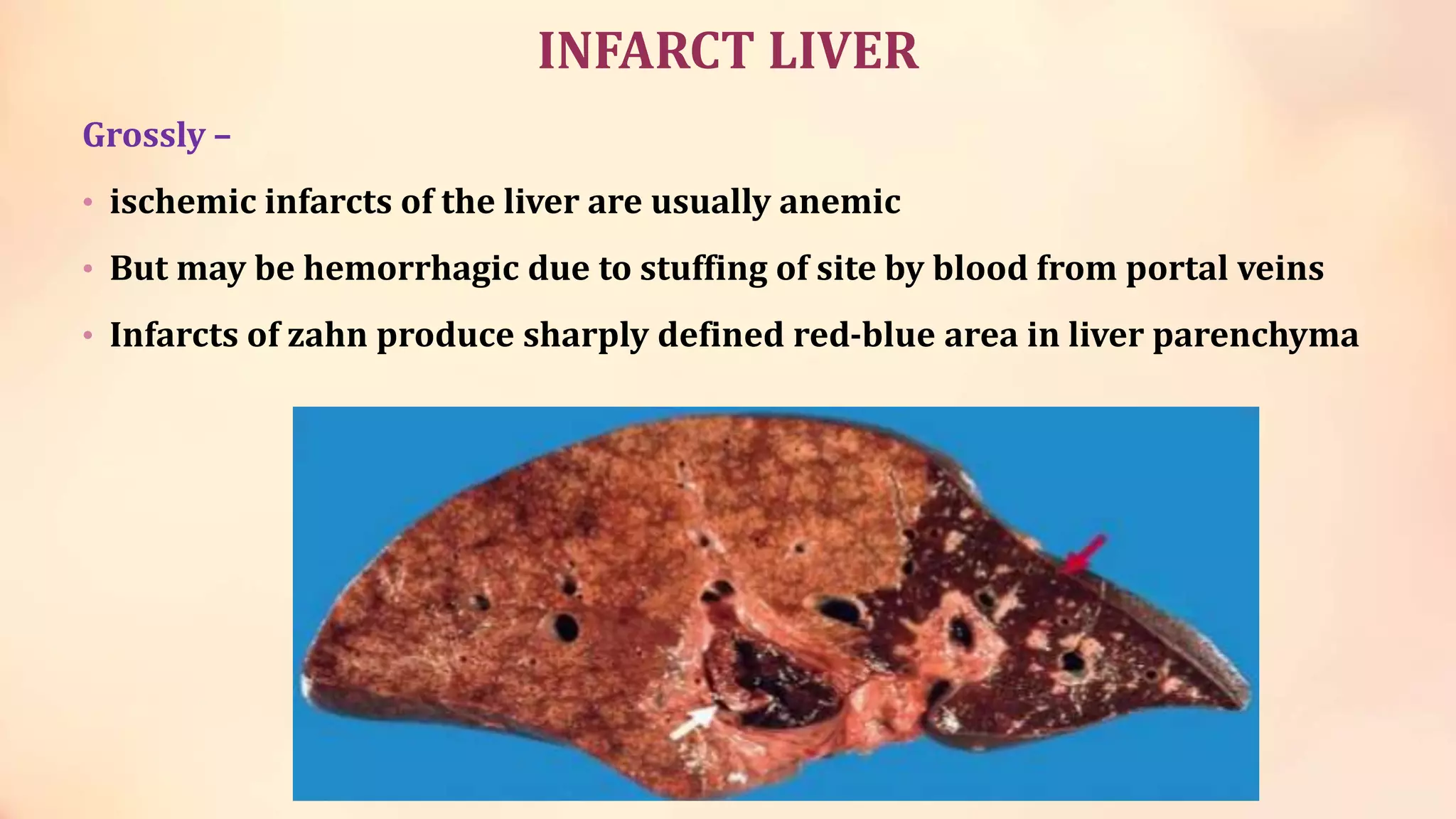 ischemia-and-infarction.ppt