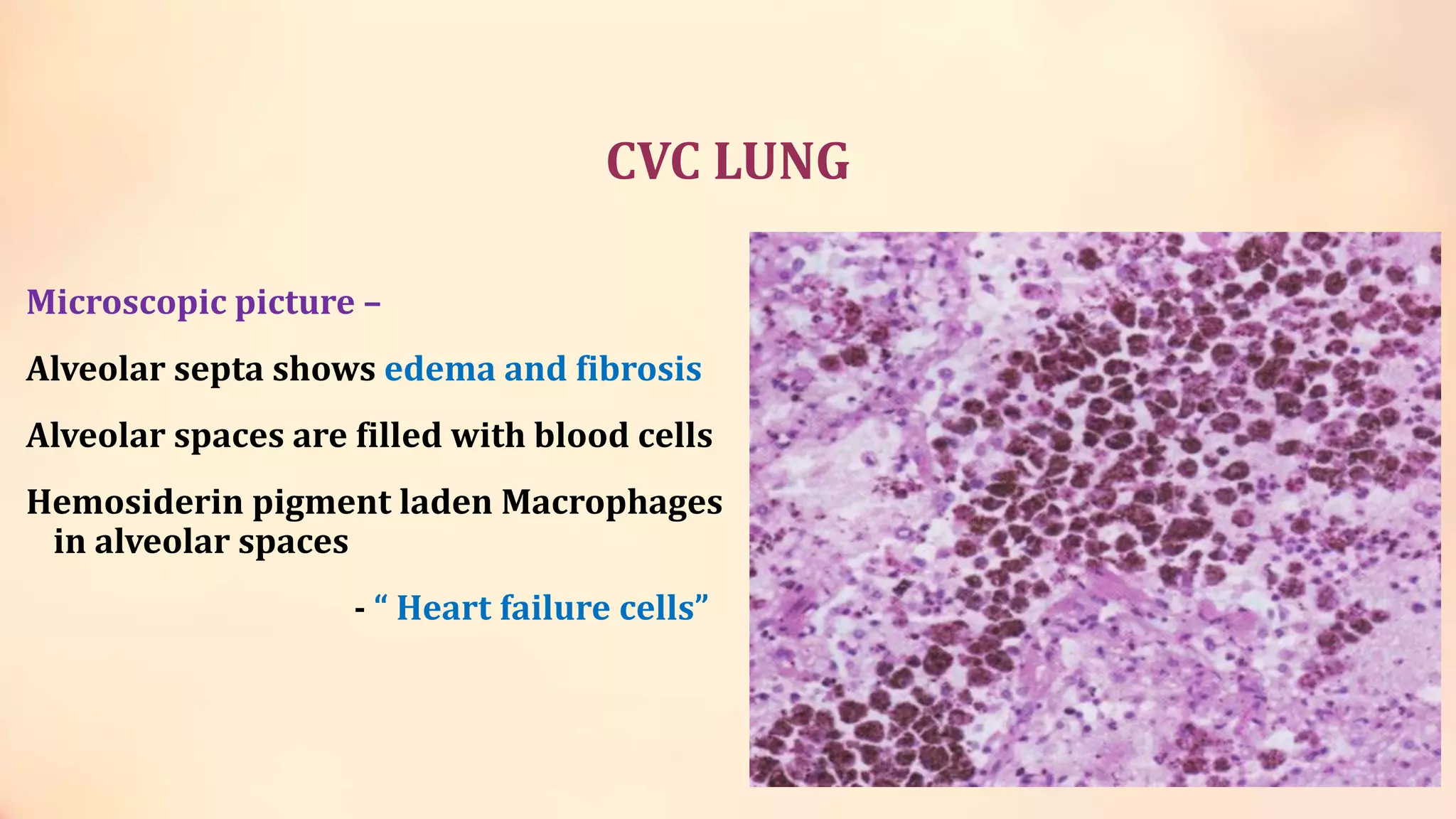 ischemia-and-infarction.ppt
