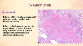 ischemia-and-infarction.ppt