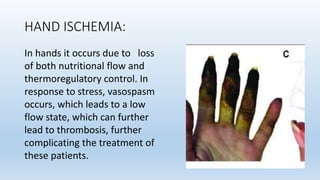 Ischemia 044 | PPT