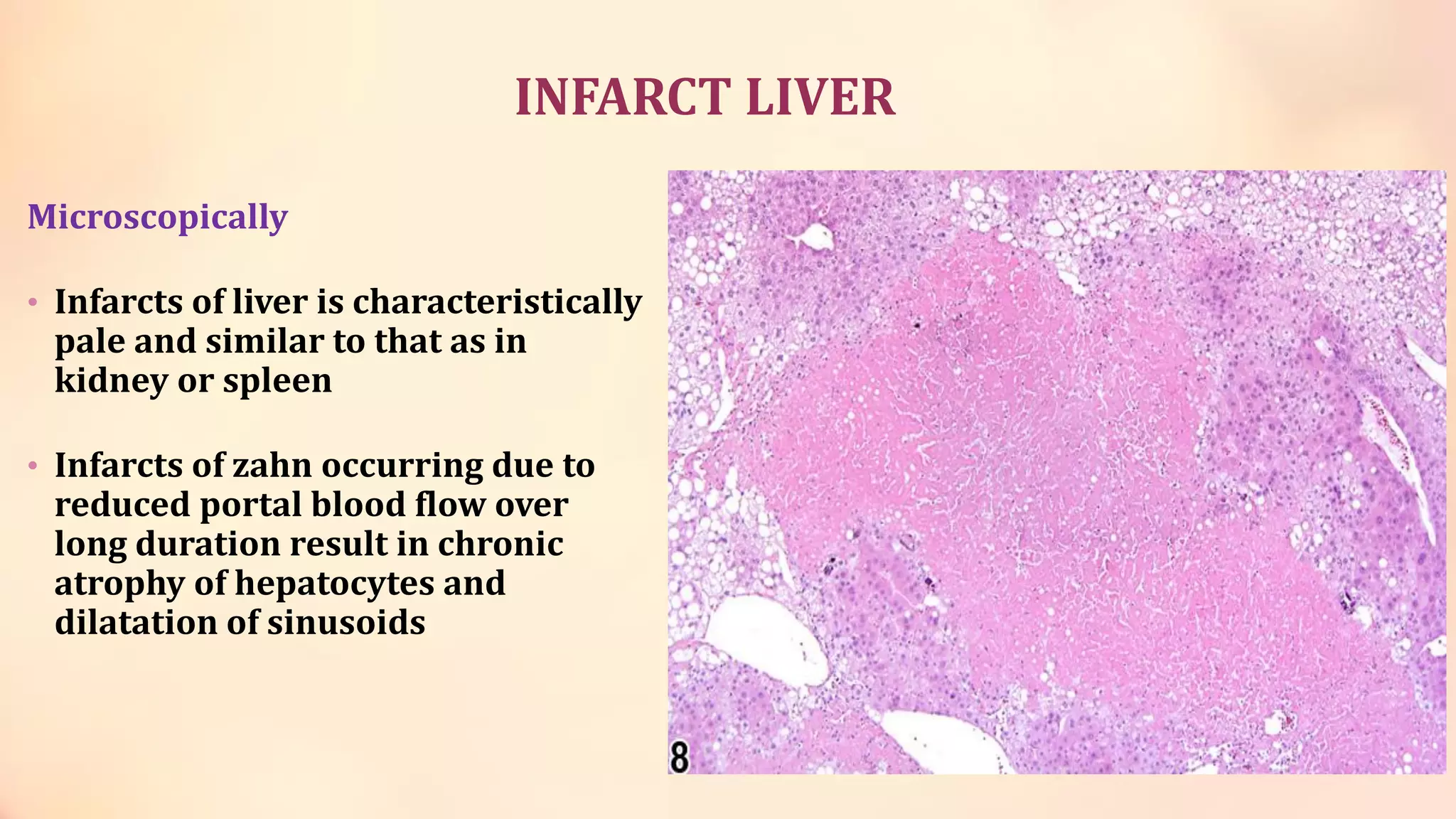 ischemia and infarction.pdf
