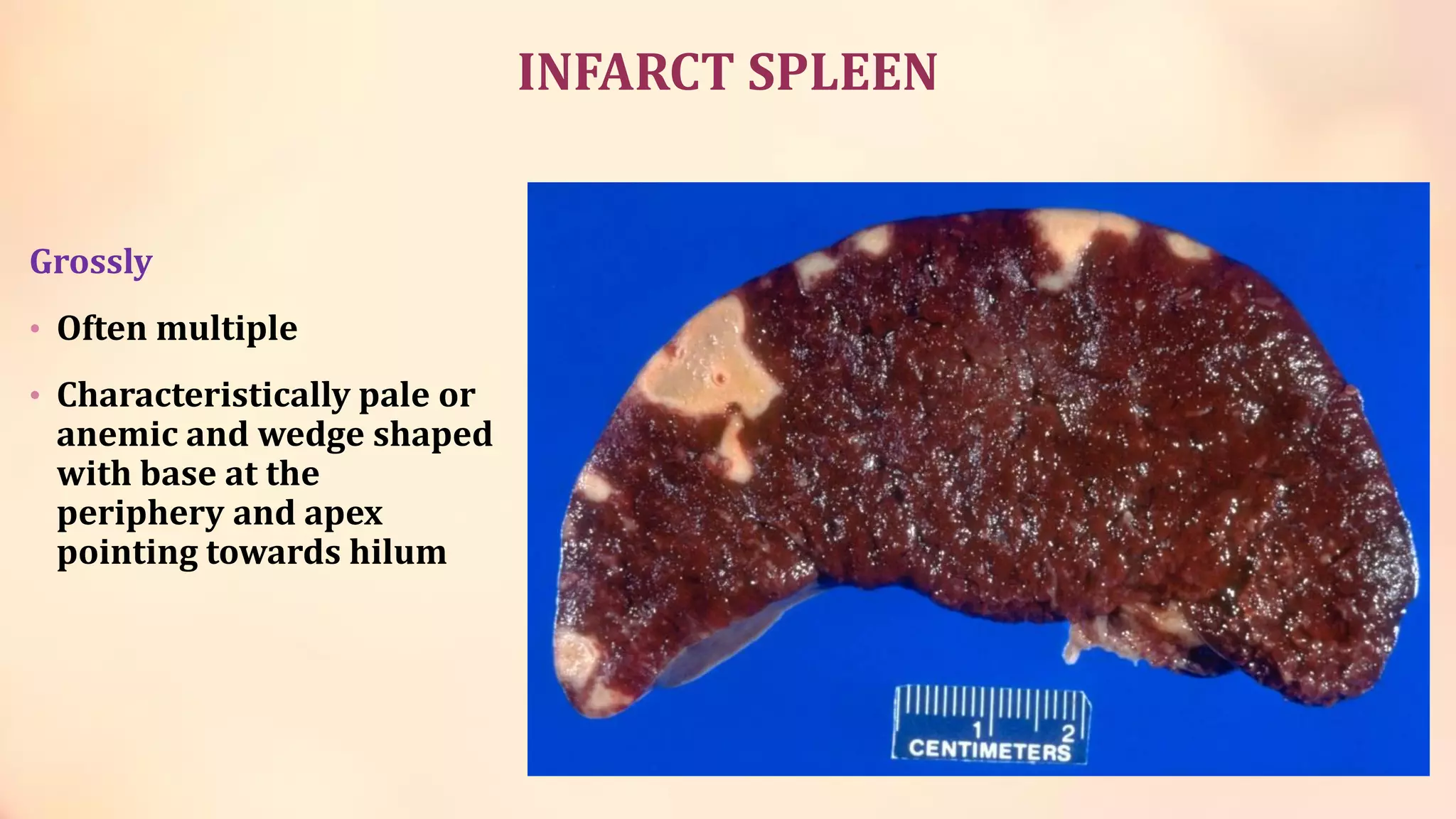 ischemia and infarction.pdf
