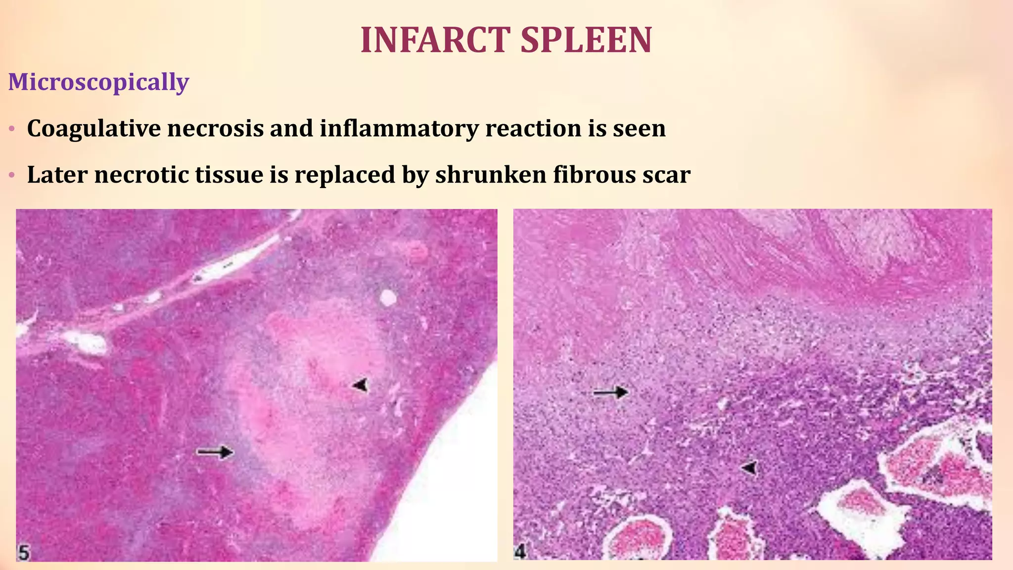 ischemia and infarction.pdf