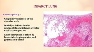 ischemia and infarction.pdf