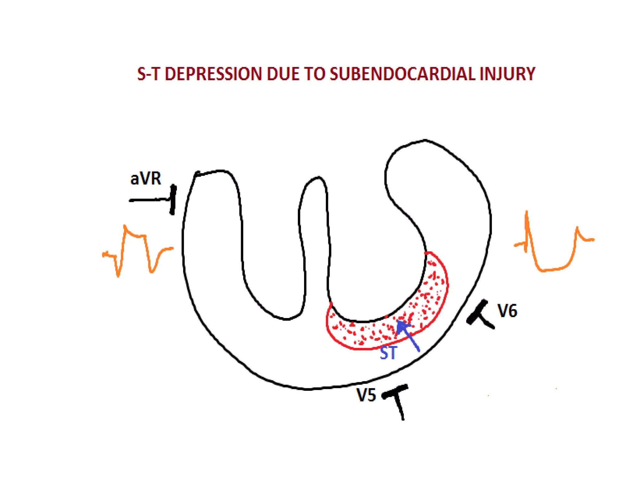 ECG changes in myocardial Ischemia and injury | PPTX