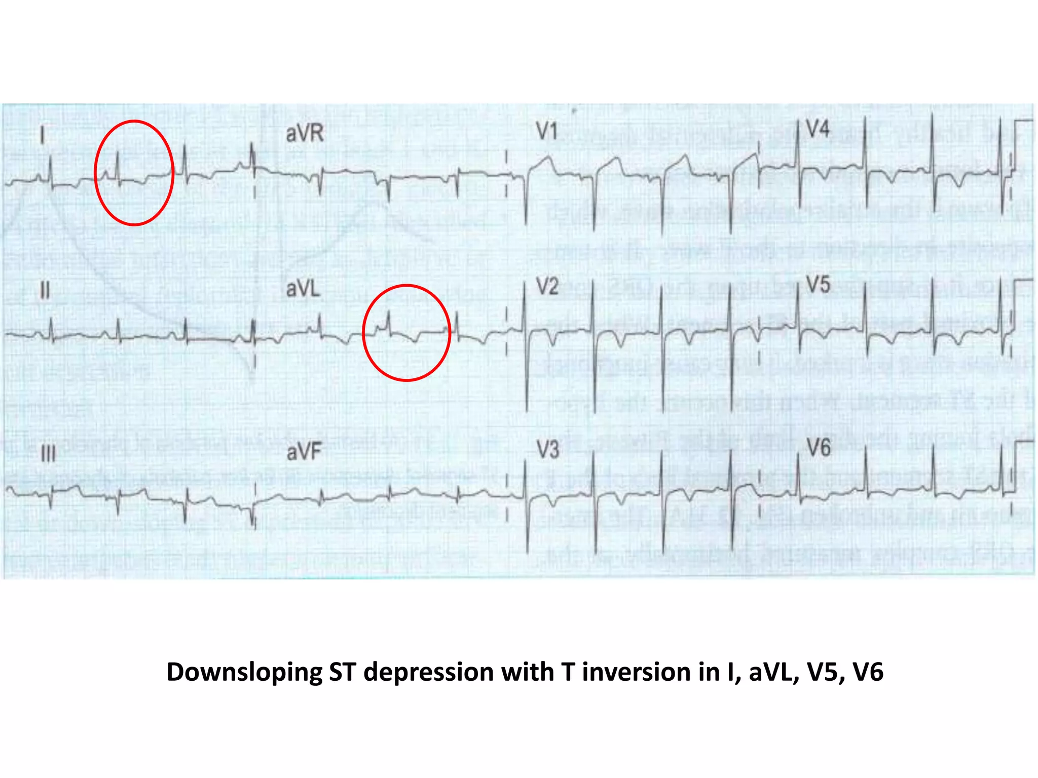 ECG changes in myocardial Ischemia and injury | PPTX