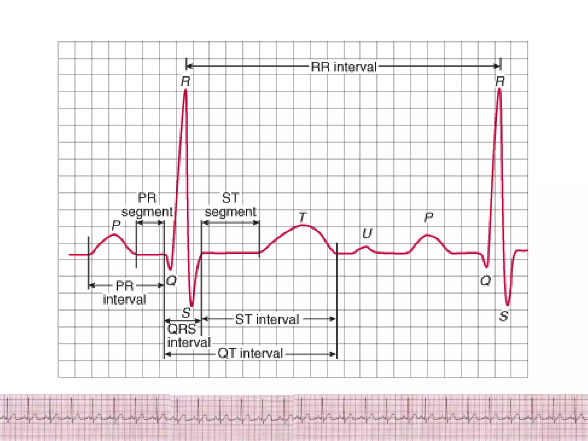ECG changes in myocardial Ischemia and injury | PPTX