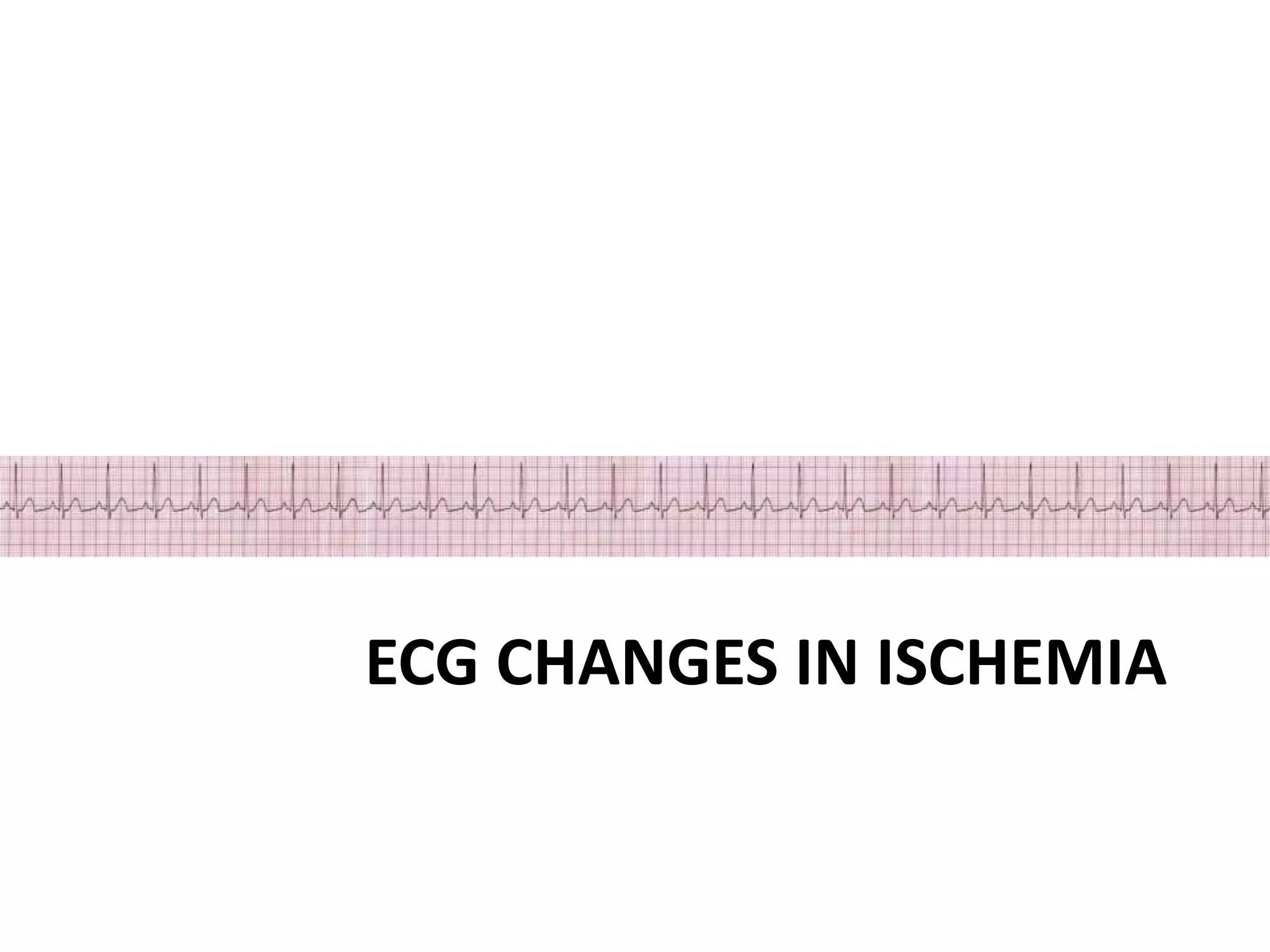 ECG changes in myocardial Ischemia and injury | PPTX